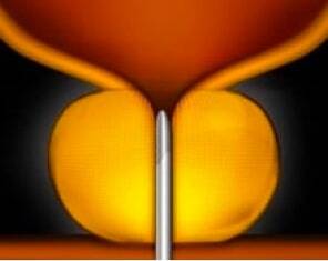 How the UroLift System Relieves BPH Symptoms