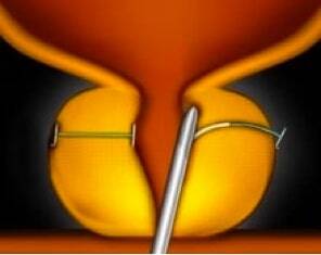 Physician Information on the UroLift System