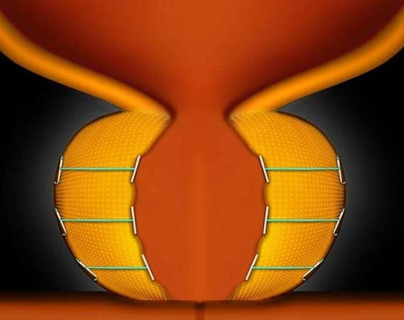 Physician Information on the UroLift System