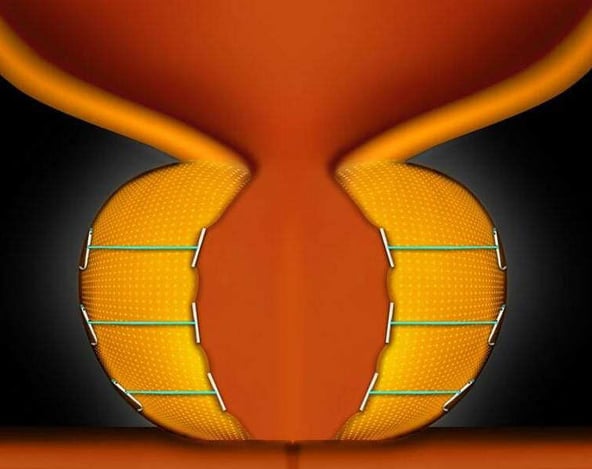 Physician Information on the UroLift System